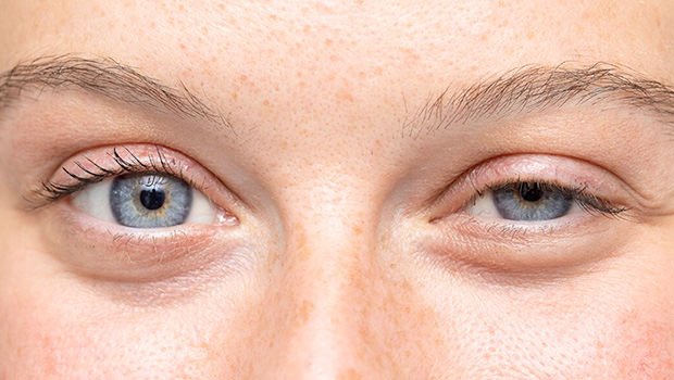 Ptose Palpebral: Como Resolver A Pálpebra Caída - Cornea Clinic