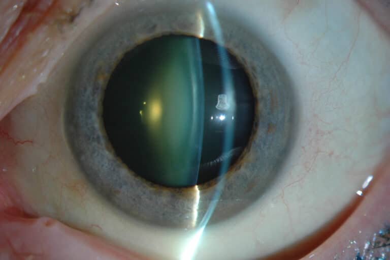 Catarata E As Lentes Intraoculares: Guia Definitivo Para Entender A ...